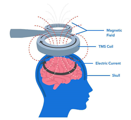 Transcranial magnetic stimulation (TMS) - Siyan